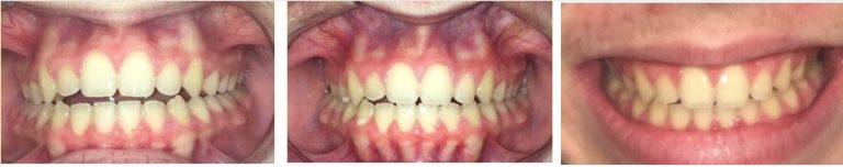 Myofunctional Therapy – OroFacialTX